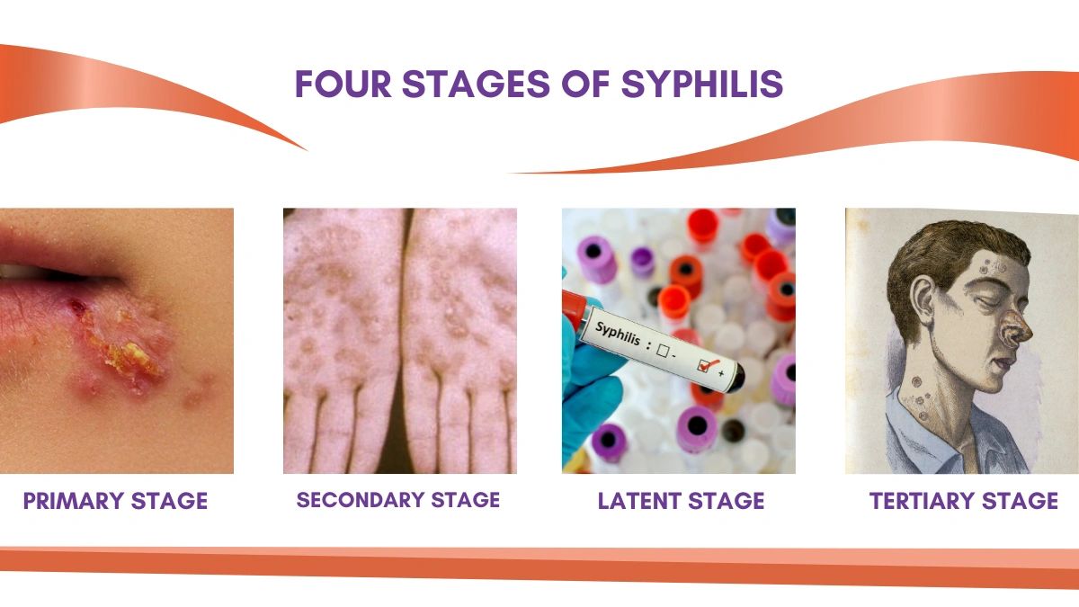 Syphilis In Men Stage 1